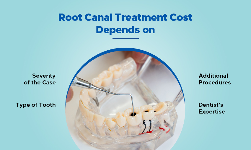 Understanding Root Canal Treatment Cost and Quality